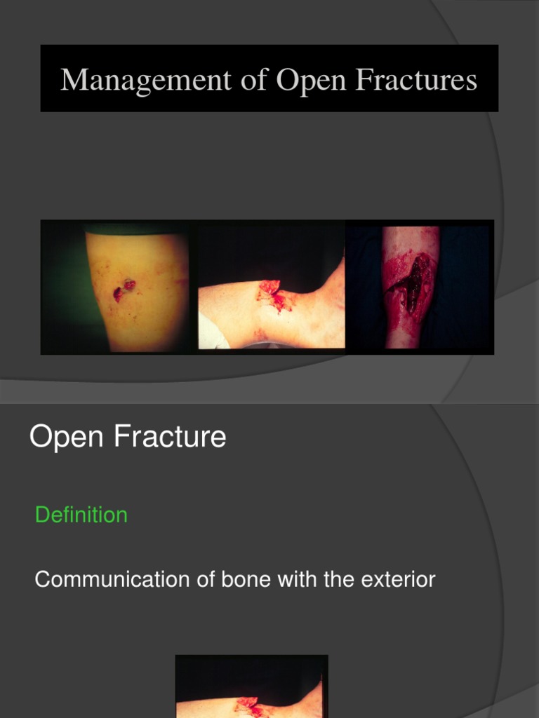 Management of Open Fractures | PDF | Wound | Bone