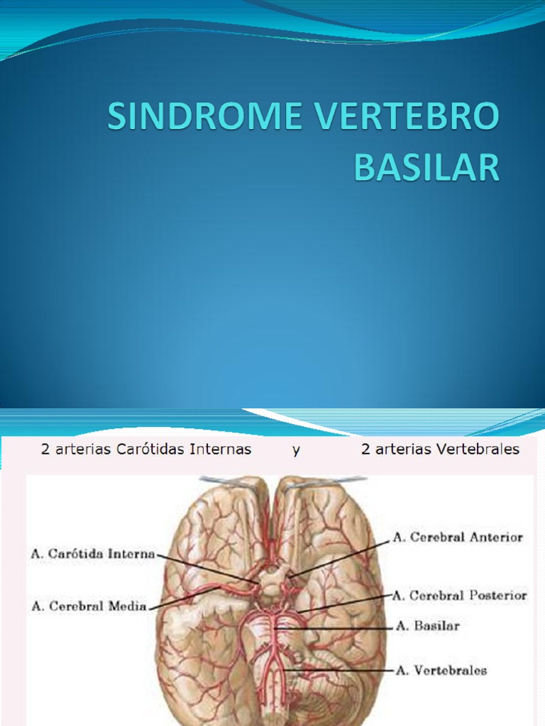 Sindrome Vertebro Basilar Expo Diapos | Carrera | Enfermedades y trastornos