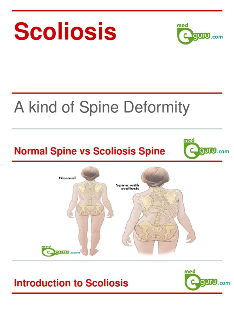 Scoliosis: A Kind of Spine Deformity | PDF | Scoliosis | Surgery
