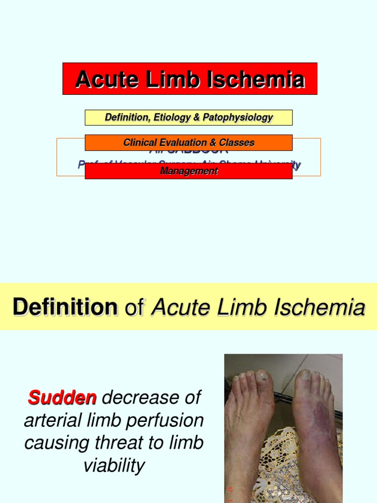 Acute Limb Ischemia Site | Ischemia | Embolism