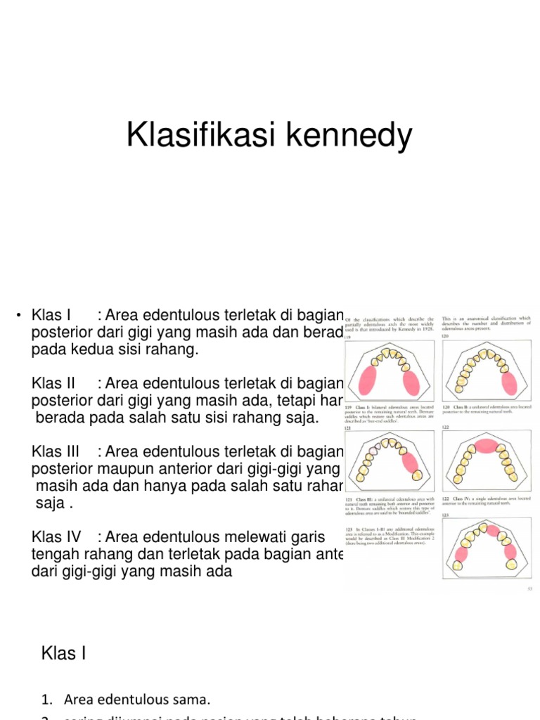 Klasifikasi Kennedy