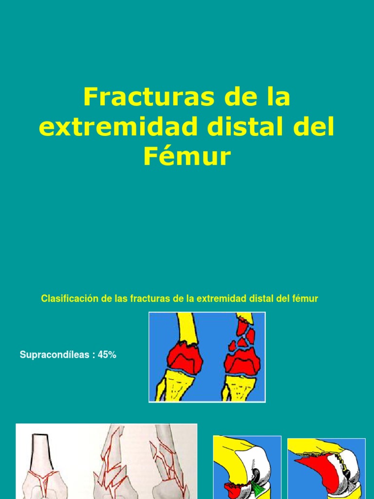 02 - Fractura Del Extremo Distal Del Femur | PDF | Rodilla ...