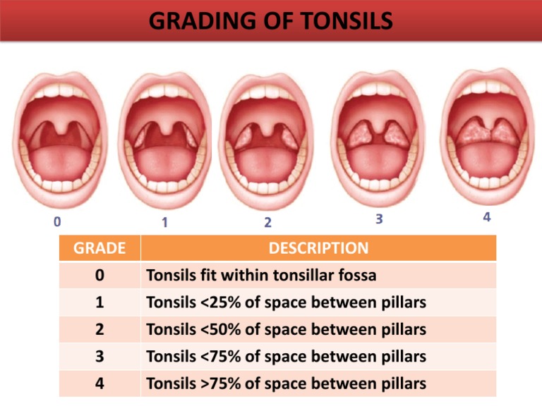 Grading of Tonsil | PDF