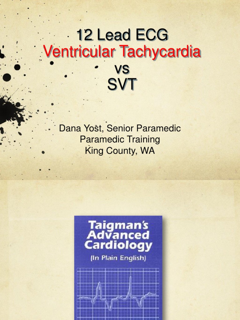 Ventricular Tachycardia: 12 Lead ECG Vs SVT | PDF