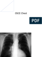 Hilum Overlay Sign in Chest Imaging | PDF