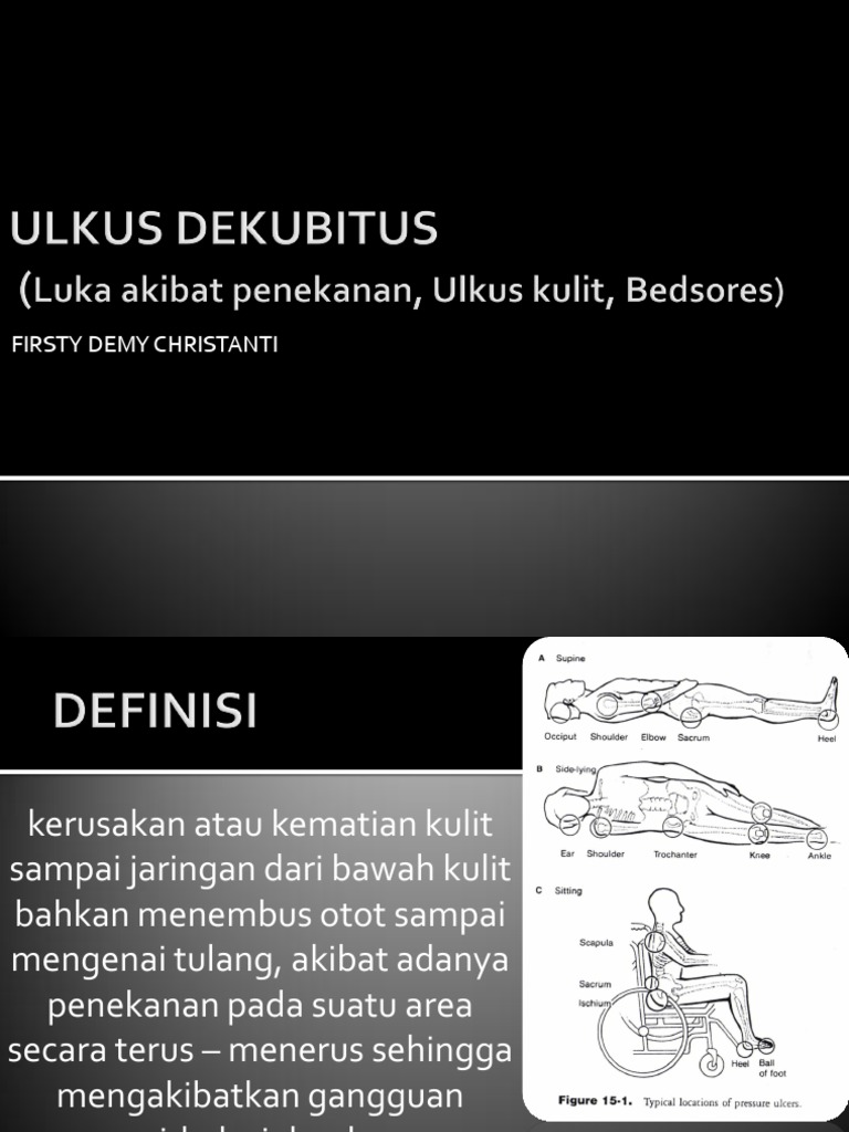 Ulkus Dekubitus | PDF