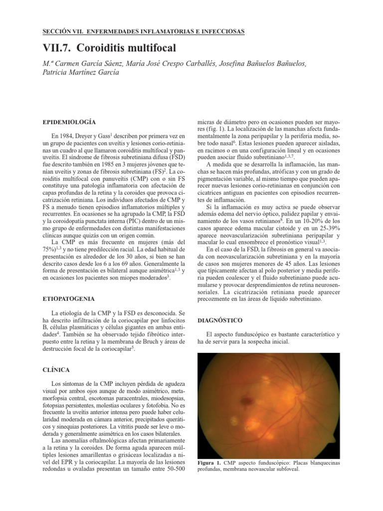 Coroiditis multifocal: una enfermedad inflamatoria ocular que afecta a ...