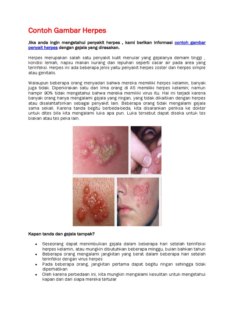 Contoh Gambar Herpes | PDF