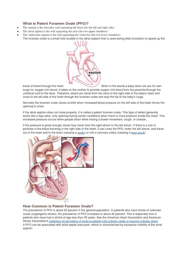 What Is Patent Foramen Ovale | PDF | Atrium (Heart) | Stroke