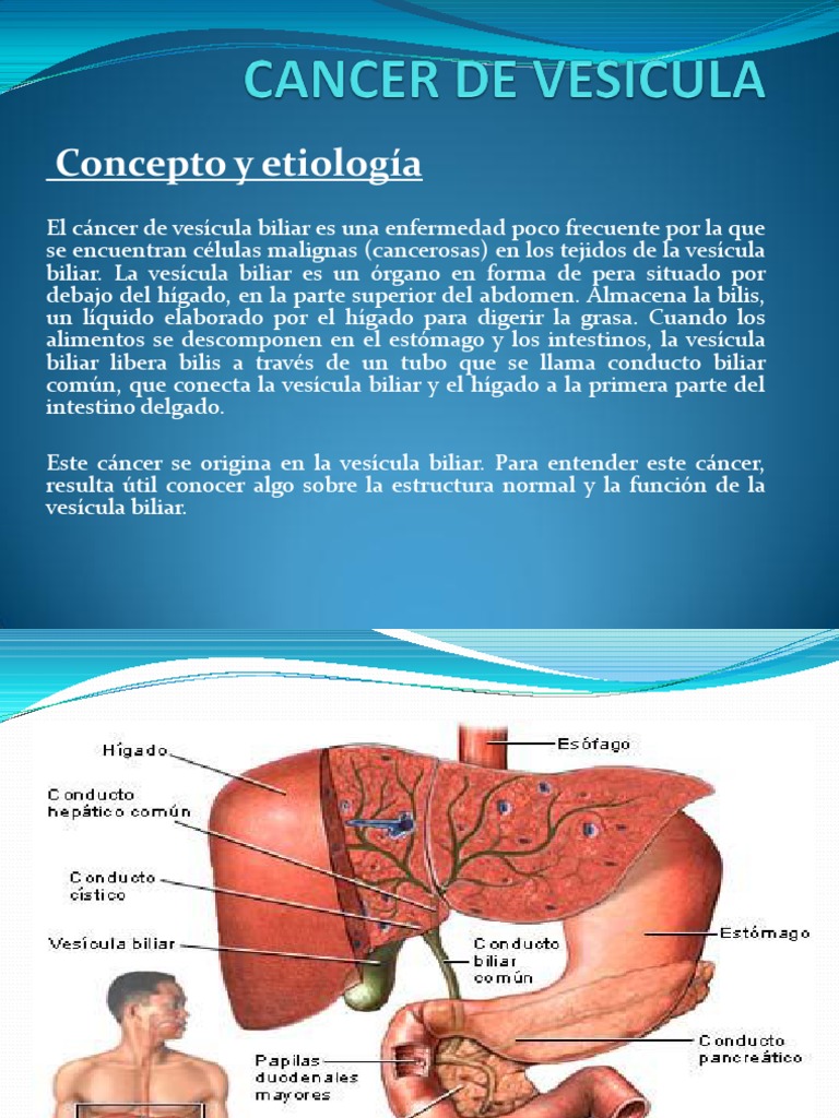 Cáncer de Vesícula Biliar: Conceptos y Riesgos | PDF | Vesícula biliar ...