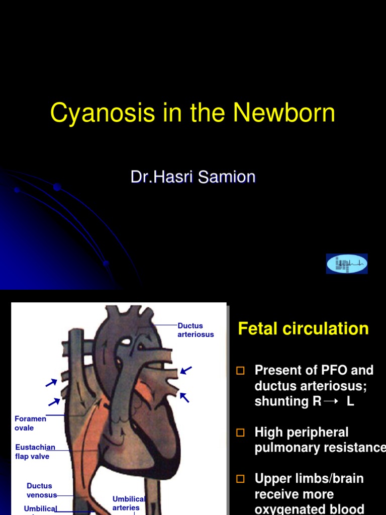 Cyanosis in The Newborn | PDF | Congenital Heart Defect | Heart