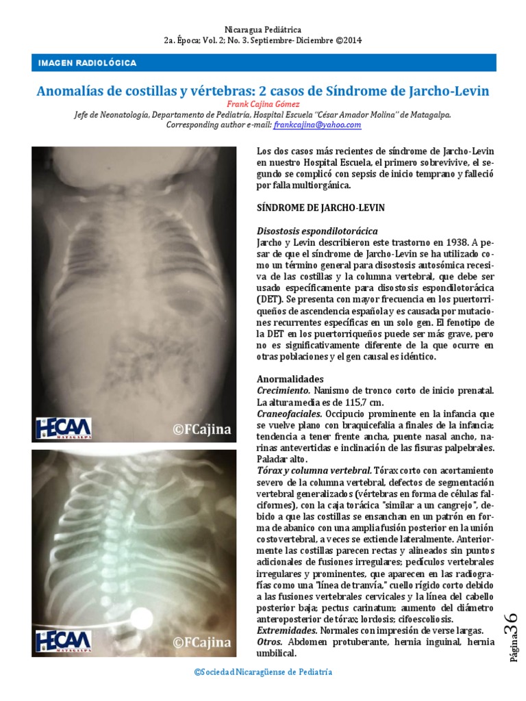 Síndrome de Jarcho Levin | Mutación | Gen