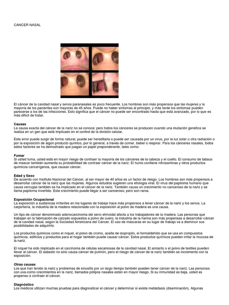 Cáncer de Nariz: Causas y Síntomas | PDF | Ct Scan | Cáncer