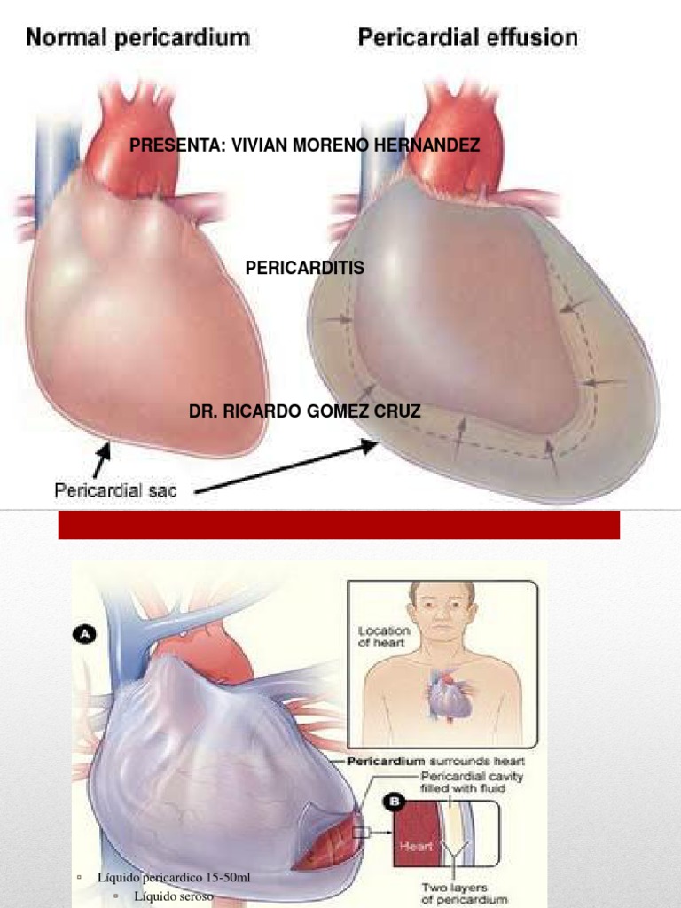 Pericarditis | Enfermedades cardiovasculares | Corazón
