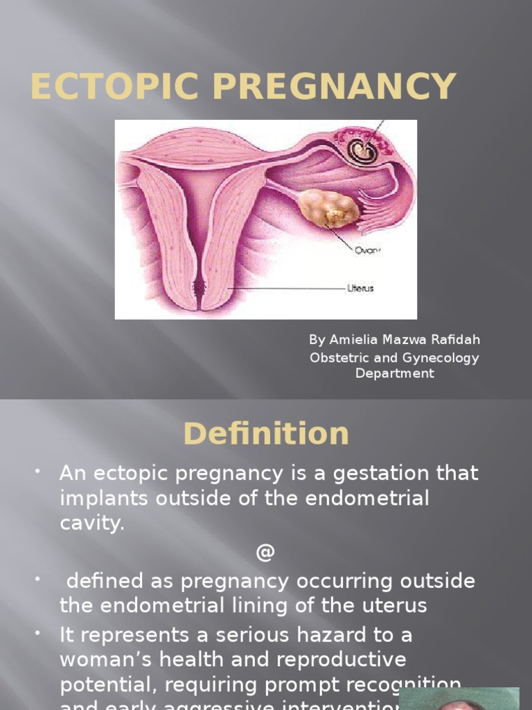 ectopicpregnancy-130330081155-phpapp02 | Women's Health | Human ...