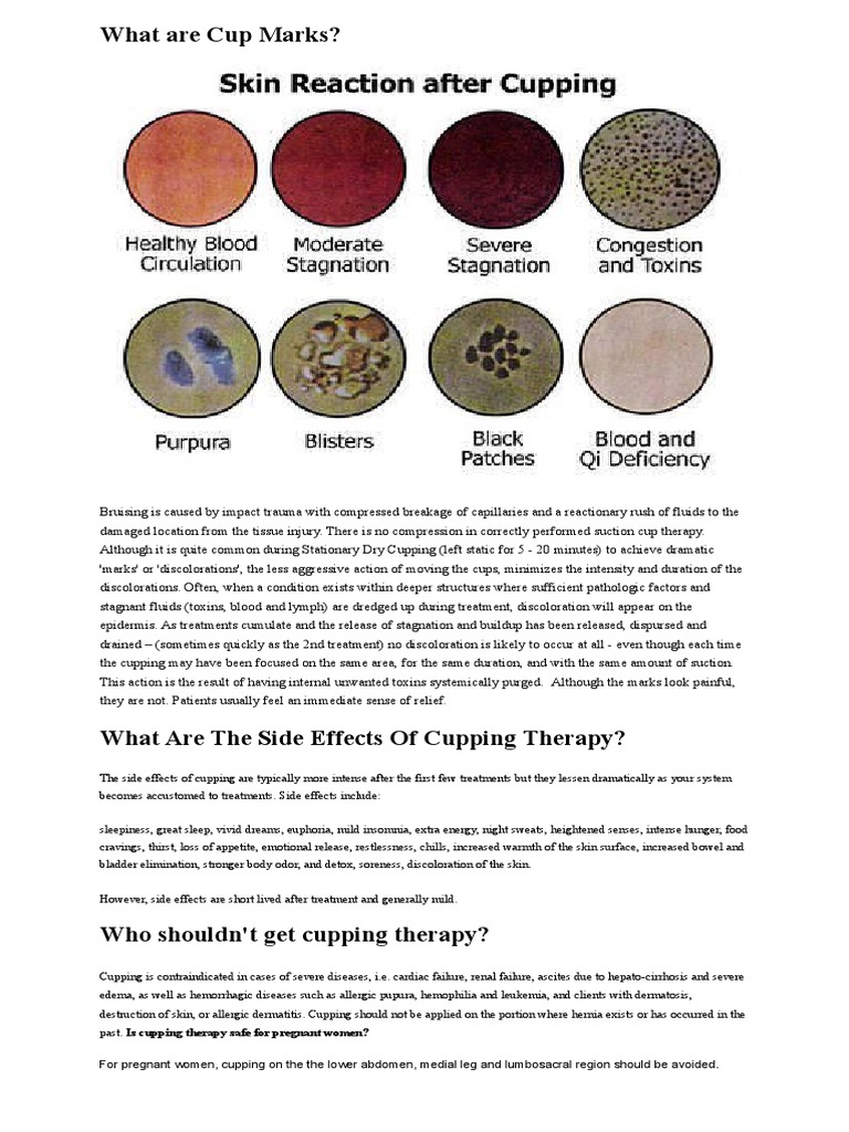Understanding Cupping Marks and Effects | PDF | Self-Improvement | Wellness