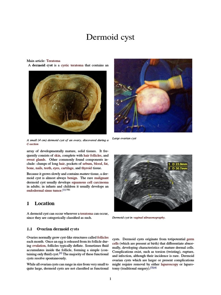 Dermoid Cyst | PDF | Medicine | Diseases And Disorders