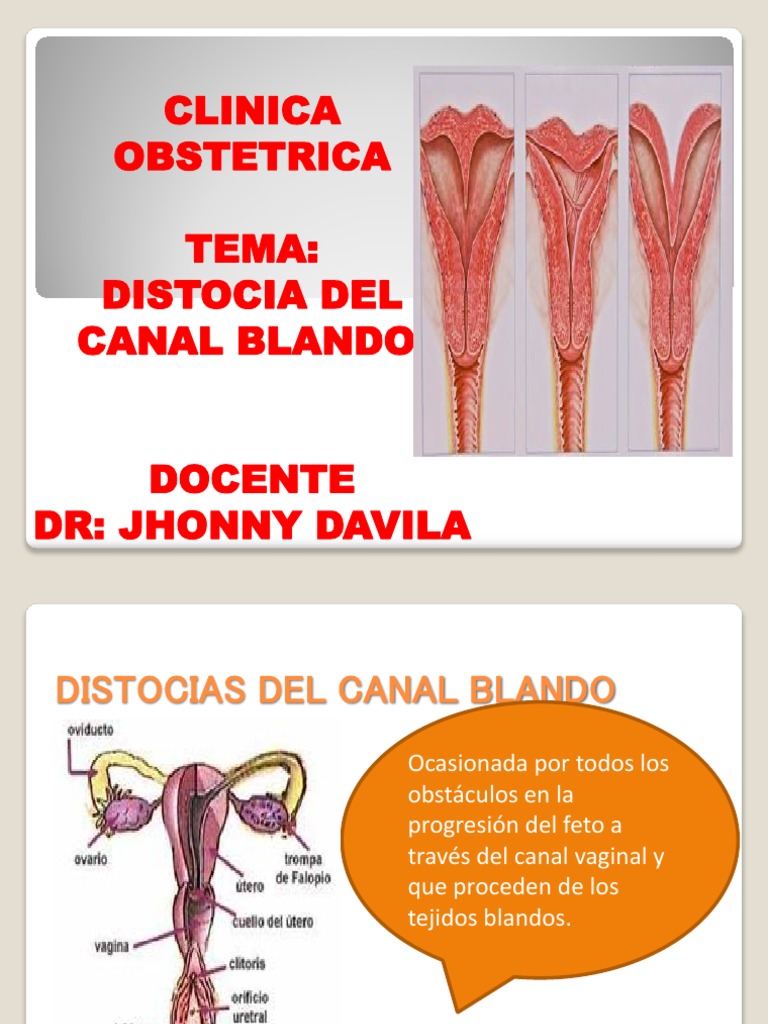 Distocia Del Canal Blando | El embarazo | Parto