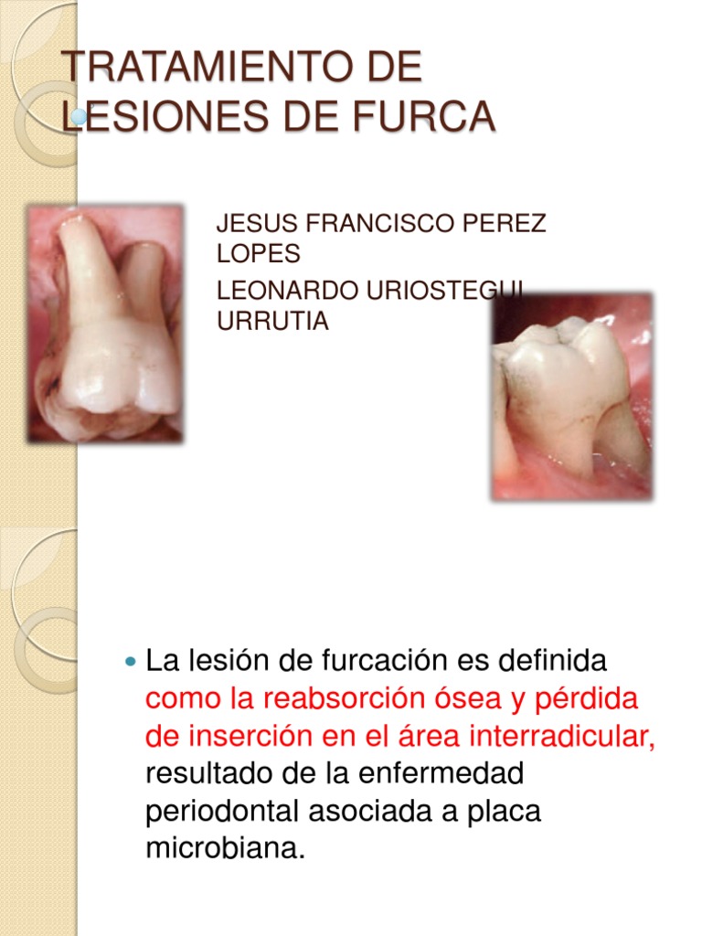 Tratamiento Lesiones de Furca | Diente humano | Odontología