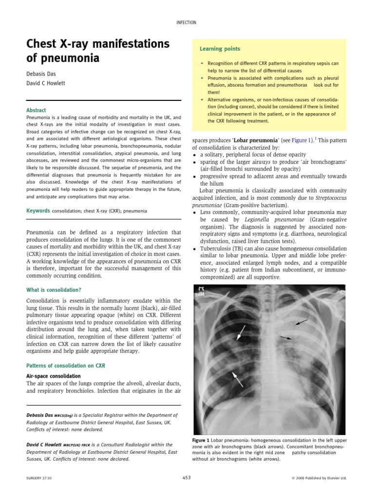 Chest X-ray Patterns Help Diagnose Pneumonia | PDF | Pneumonia | Lung
