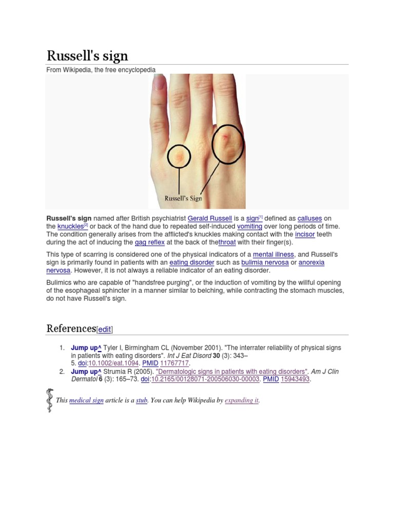 Russell's Sign | PDF | Bulimia Nervosa | Eating Disorder
