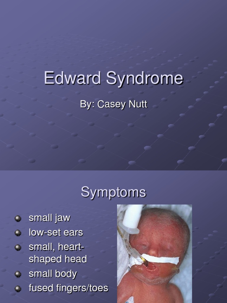Edward Syndrome | PDF