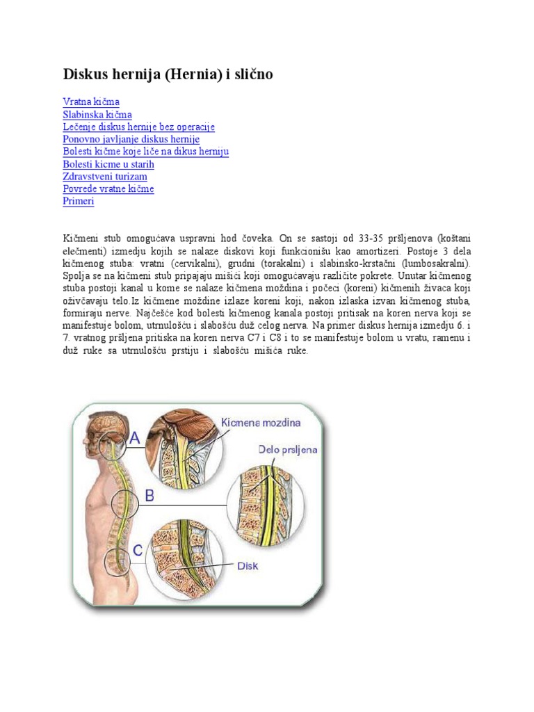 Diskus Hernija | PDF