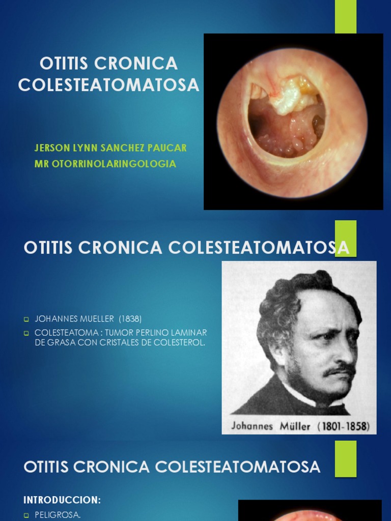 Otitis Cronica Colesteatomatosa