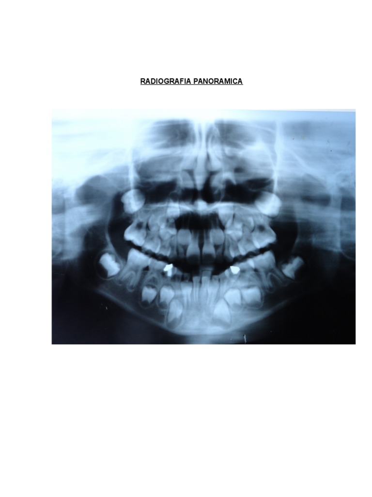 Informe de Radiografía Panorámica Dental | PDF