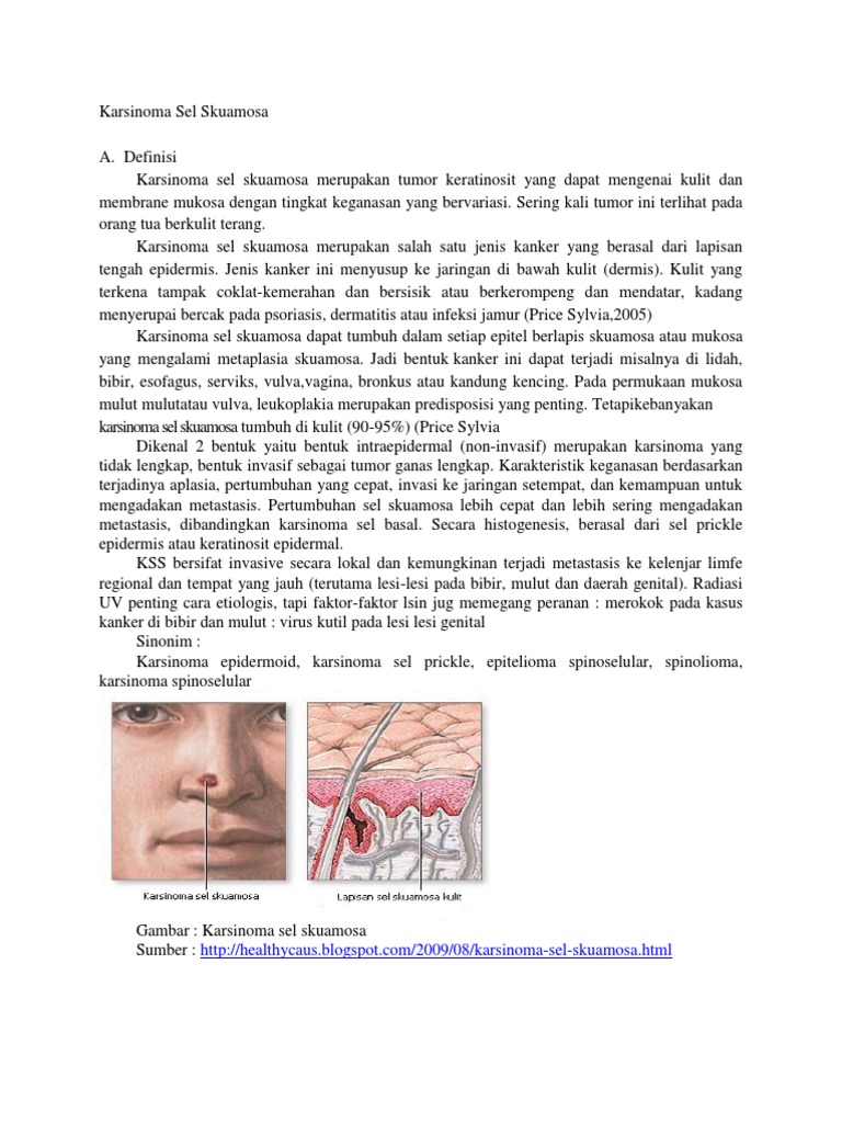 Karsinoma Sel Skuamosa: Patogenesis, Gejala Klinis, dan Diagnosis | PDF