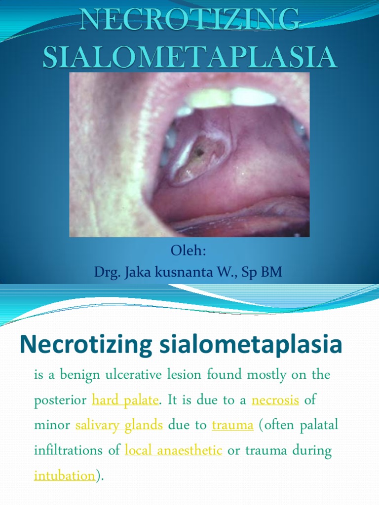 Necrotizing Sialometaplasia | PDF | Necrosis | Biopsy