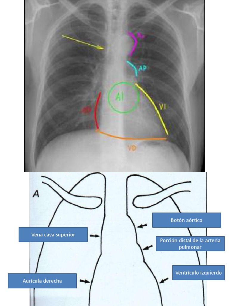 Botón Aórtico y Cardiomegalia en RX | PDF | Salud y bienestar