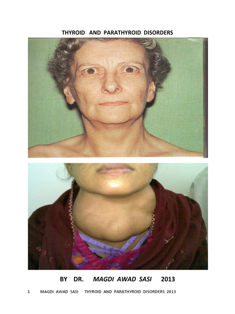 Thyroid and Parathyroid Disorders: by Dr. Magdi Awad Sasi 2013 | PDF | Hyperthyroidism ...