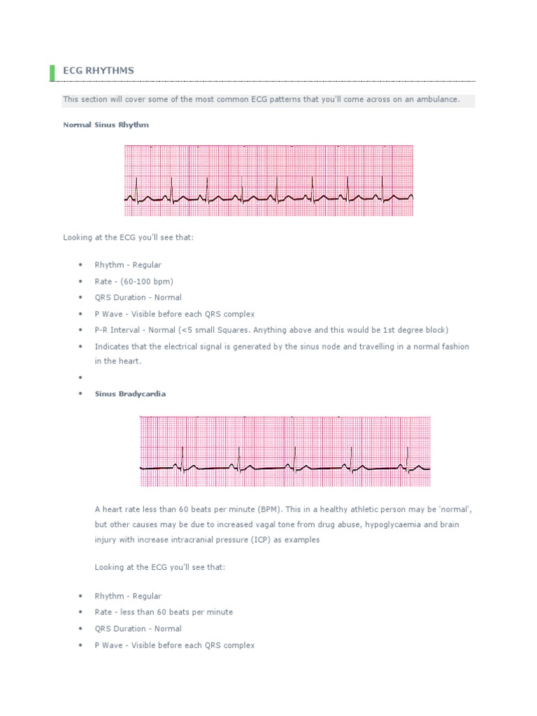 Understanding Normal Sinus Rhythm ECG | PDF