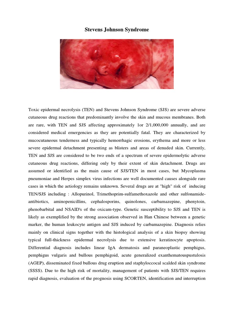 Stevens Johnson Syndrome | Diseases And Disorders | Medical Specialties