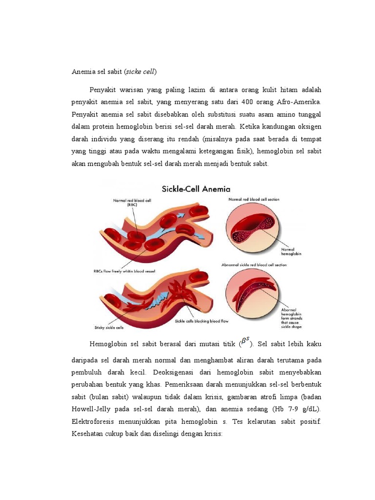 Anemia Sel Sabit (Sickle Cell) | PDF