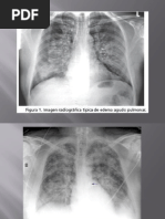 Bullas y Cavernas en Lesiones Pulmonares | PDF | Pulmón | Ct Scan