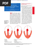 Ventricular Tachycardia - Monomorphic VT - LITFL | PDF ...
