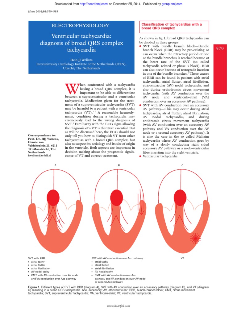 VT Vs SVT Wellens | PDF | Electrocardiography | Visual Cortex
