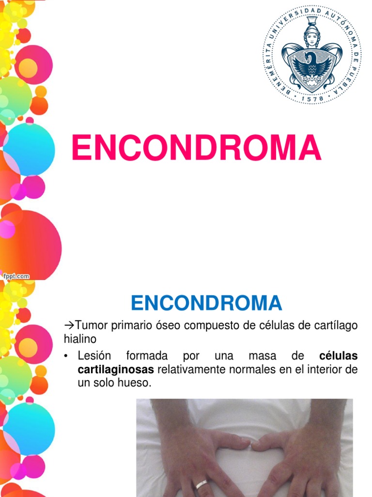 Encondroma | PDF | Hueso | Cartílago