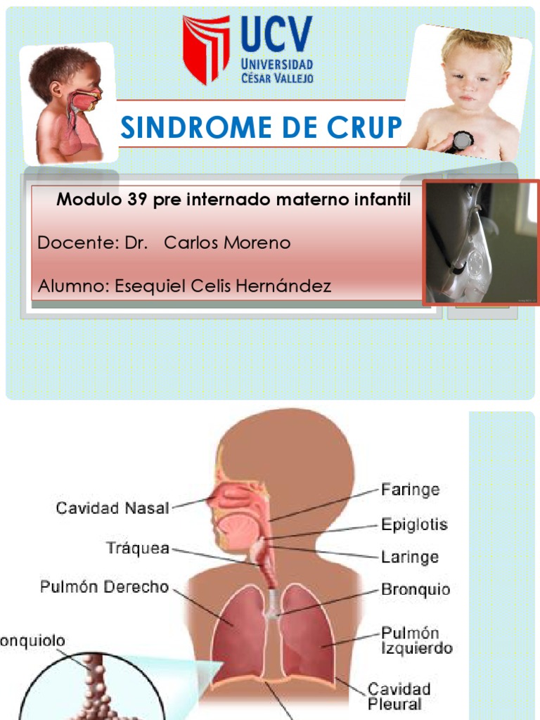 Síndrome de Crup en Niños: Guía Clínica | PDF | Enfermedades ...