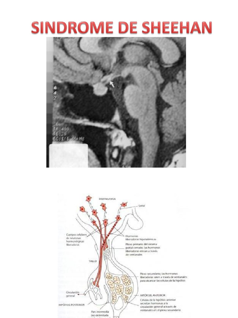 Síndrome de Sheehan: Infarto Hipofisario | PDF