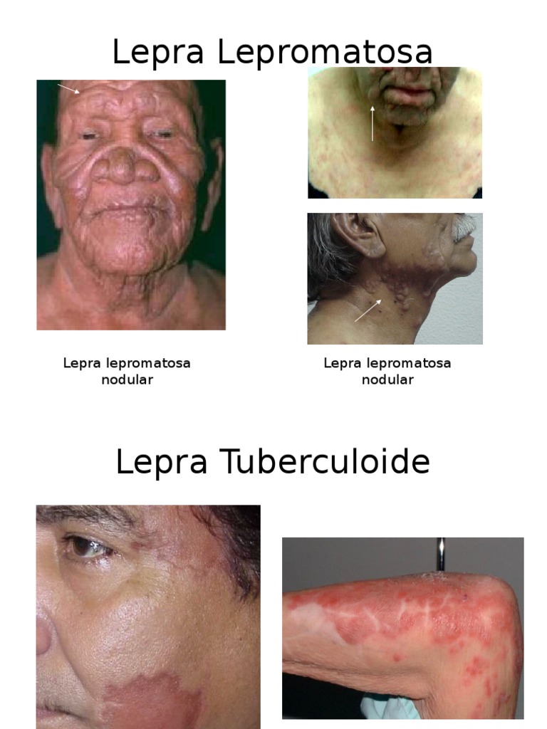 Tipos de Lepra: Lepromatosa y Tuberculoide | PDF | Ficción general