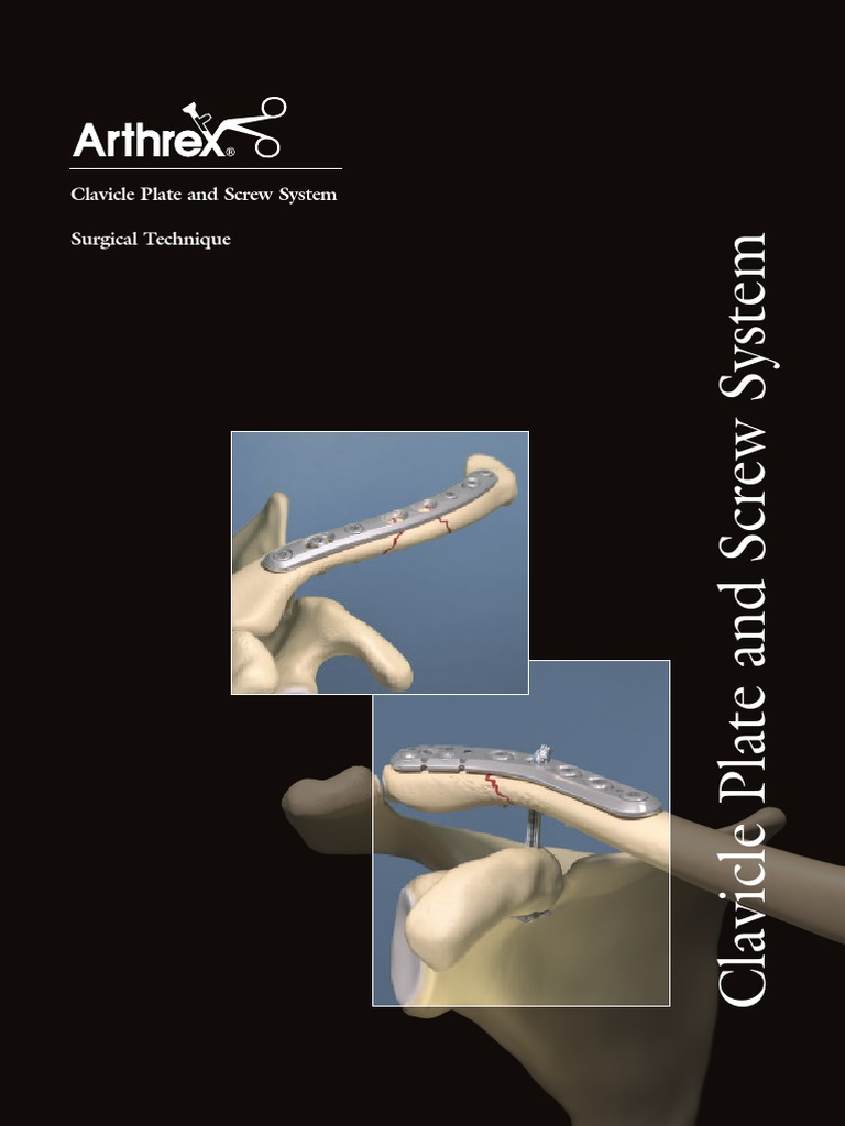 Clavicle Plate and Screw System Surgical Technique | Screw ...