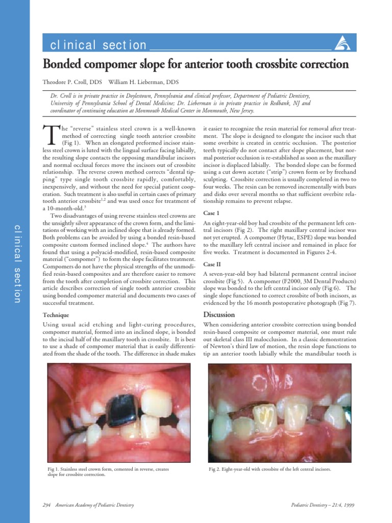 Compomer Crown | PDF | Dental Composite | Dentistry