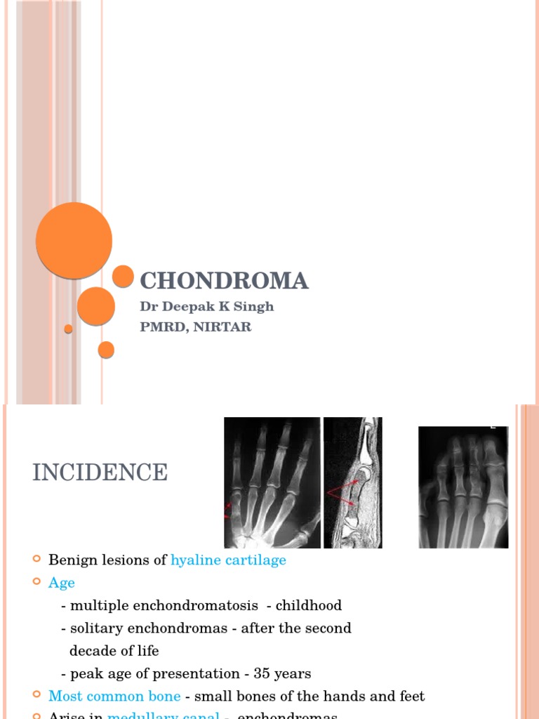 Chondroma | PDF | Bone | Cartilage
