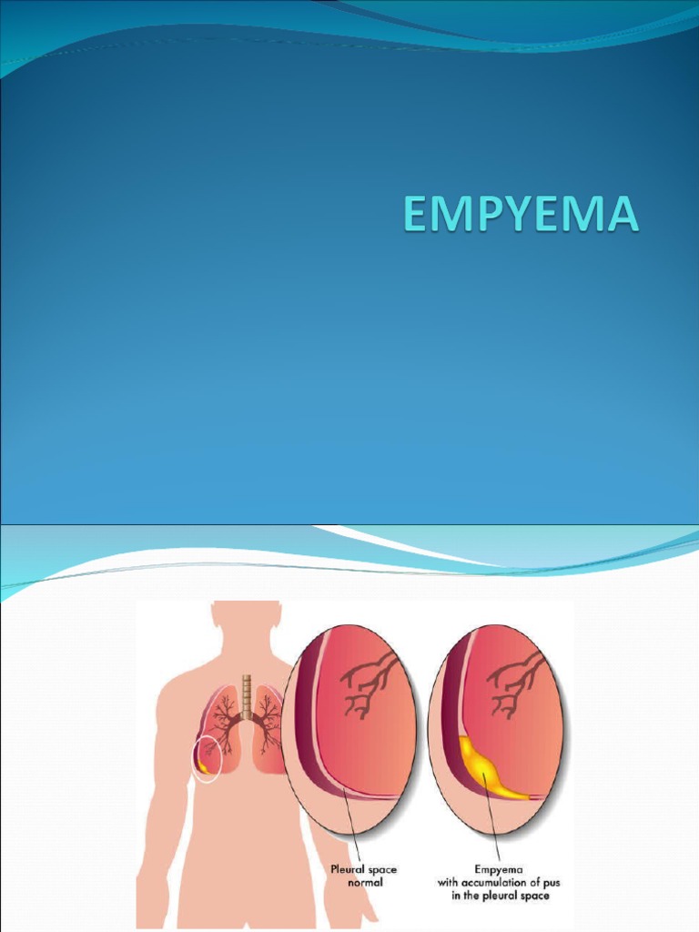 Empiema | PDF