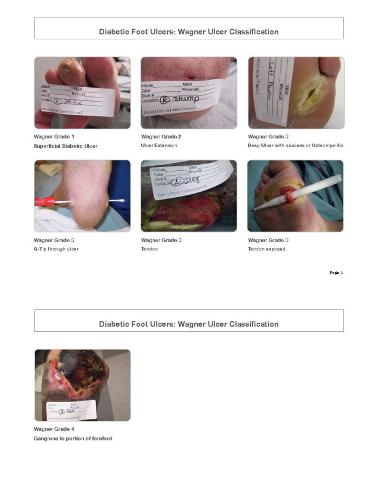 Diabetic Ulcers Wagner Grades | PDF | Dermatology | Epidemiology