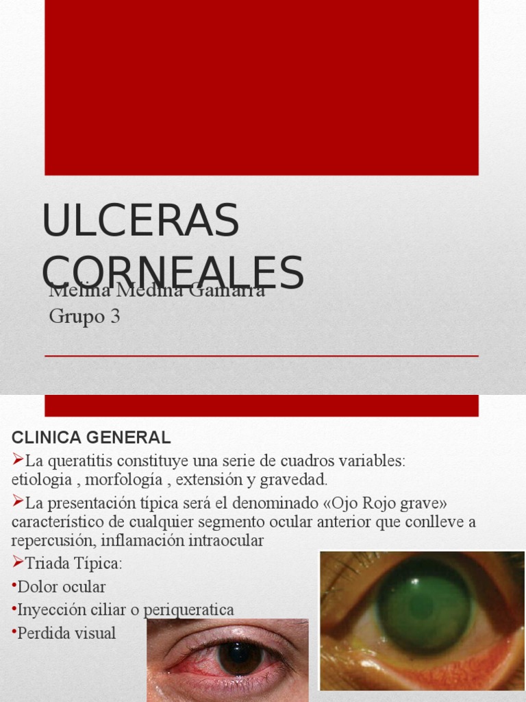 ULCERAS CORNEALES | Ojo humano | Córnea