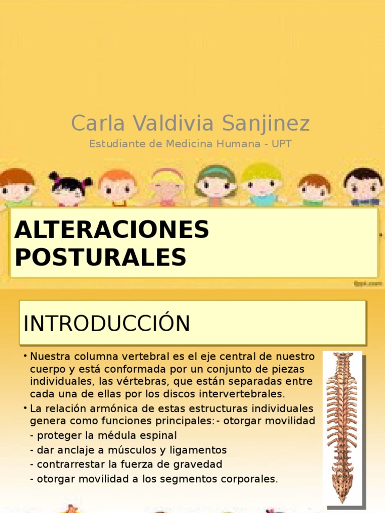 Síndrome de Espalda Plana y Escoliosis | PDF | Escoliosis | Vértebra